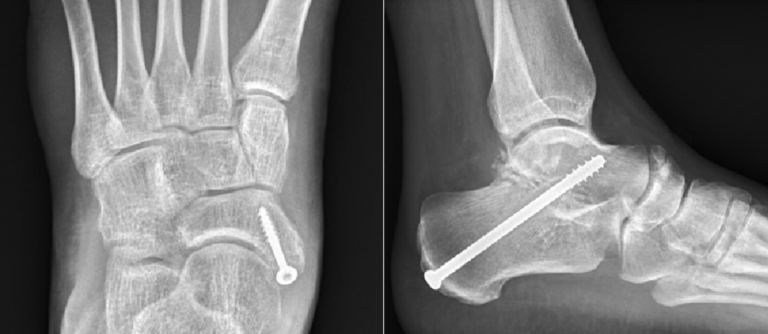 flat foot pes planovalgus