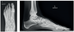 Osteoarthritis hind foot and mid foot
