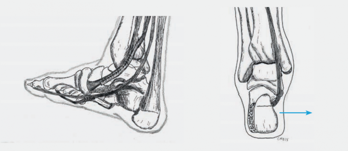 flat foot pes planovalgus