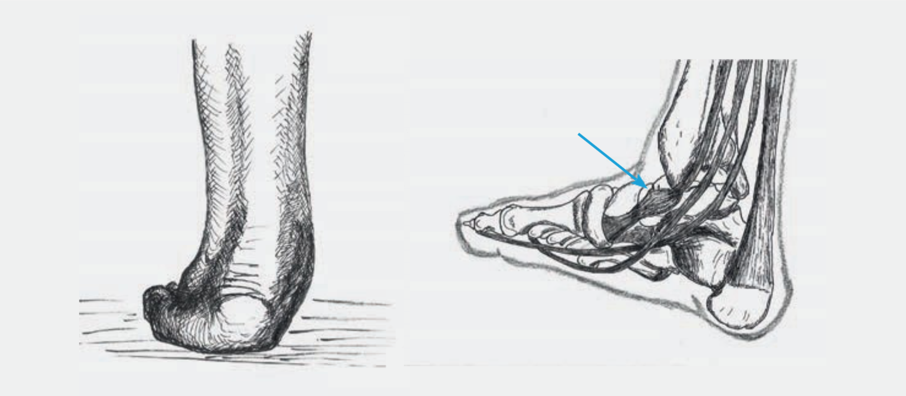 Knickfuss – Leonardo