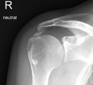 Tendinitis Calcarea / the Calcified Shoulder – Leonardo